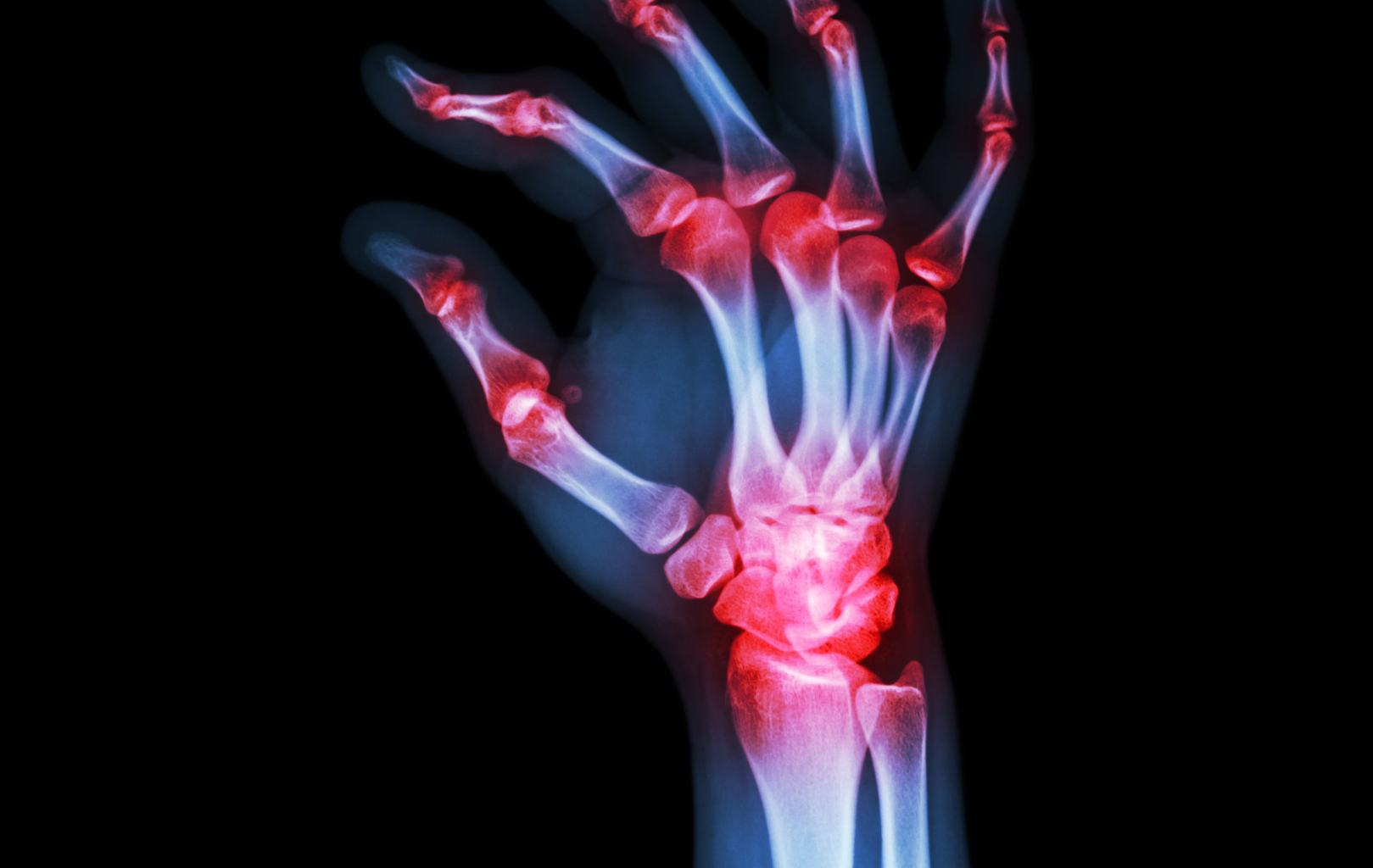 Newly discovered species of bacteria in the microbiome may be a culprit ...