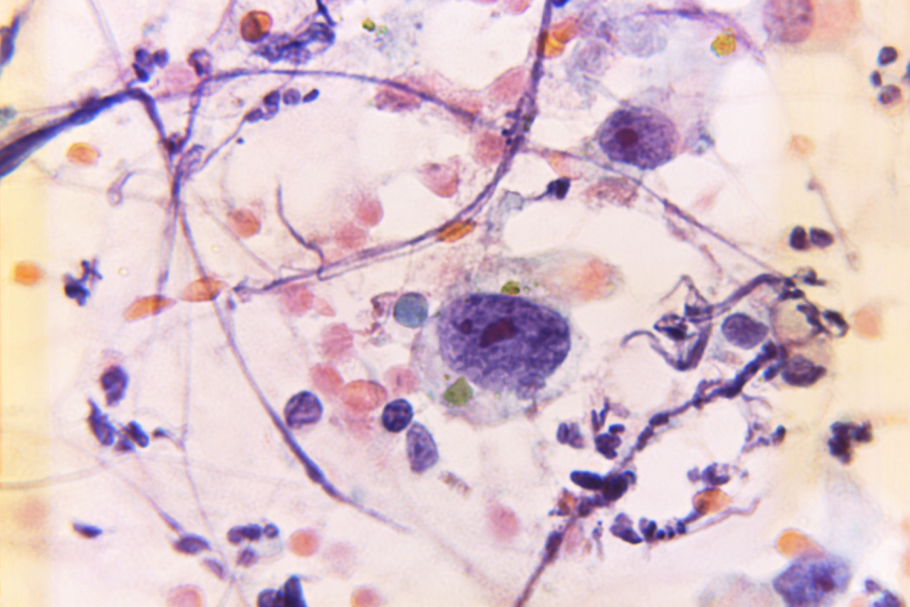 What Do These “Stages” of Cancer Really Mean? - Modern Sciences